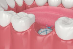Socket Preservation | Perio PDX